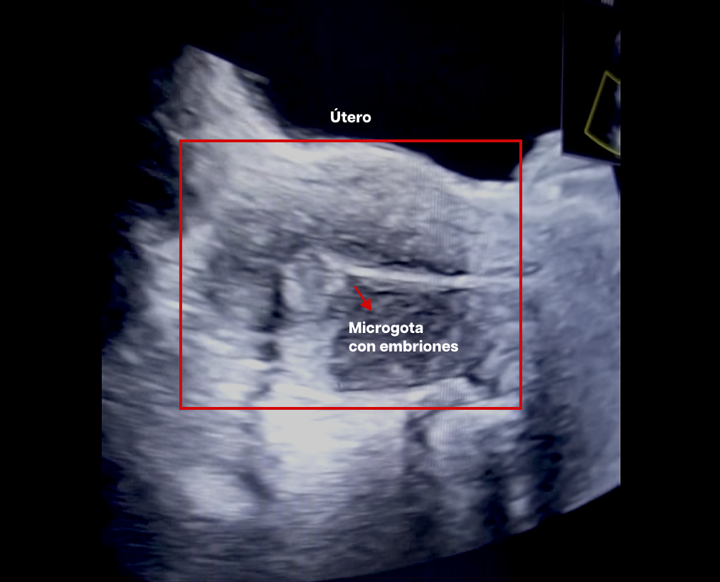 Transferencia embrionaria – Guía de Reproducción Asistida